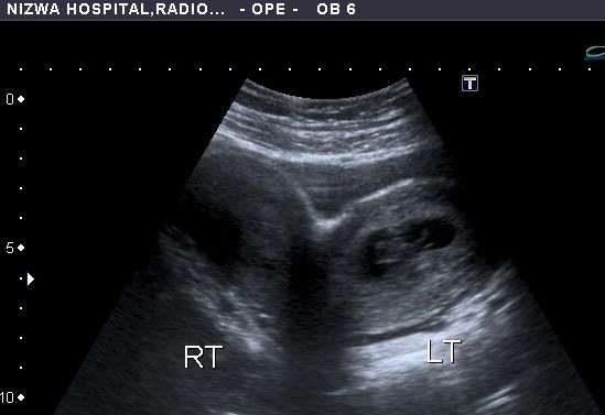 Didelphys Uterus Ultrasound
